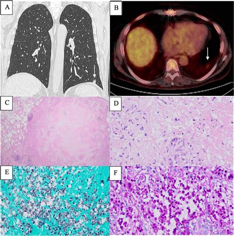 Spiculated Nodule In A Lung Transplant Recipient Localized