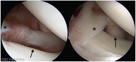 The Buford Complex Redefined A Pathologic Morphology In Sheeps Clothing Pmc