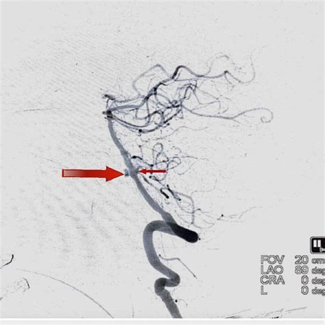 Dsa Lateral View Demonstrating An Aneurysm Directed Anteriorly Larger Download Scientific