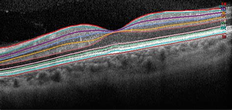 Segmentation Of The Retinal Layers Single Horizontal Foveal Scans Were Download Scientific