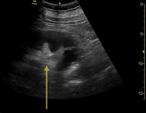 Xanthogranulomatous Pyelonephritis Case Report Journal Of Emergency