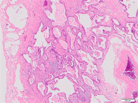 Pathology Outlines Uip Ipf