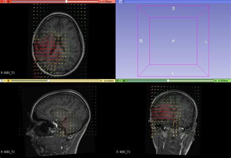 Visualization Of Deformation Field Computed By Mtled Visualization