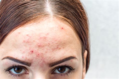 How Long Does Adult Acne Last