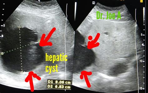 Ultrasound Imaging Simple Hepatic Cyst