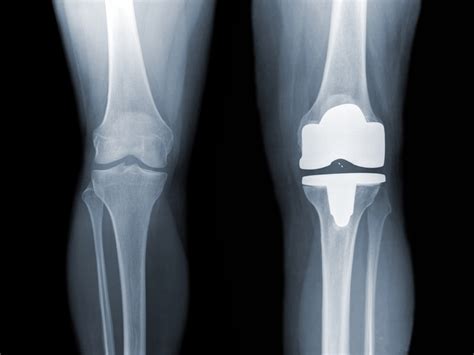Joint Replacement Pros And Cons Dales Mobile Physiotherapy