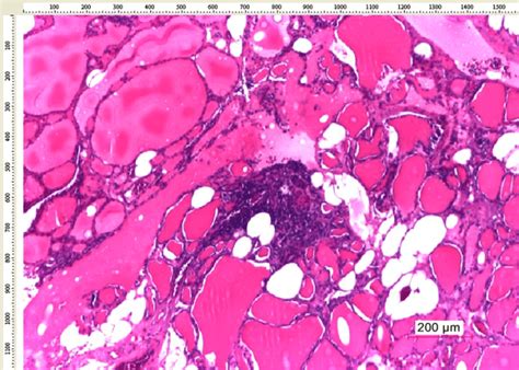 Focal Chronic Thyroiditis Focal Aggregates Of Lymphocytes In Inter Or