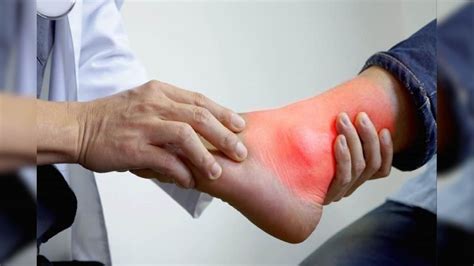 Uric Acid Healthcare Tips ইউরিক অ্যাসিড থেকে ক্ষতি হতে পারে কিডনির