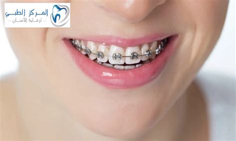 Discover Information About Dental Braces And Their Key Benefits In