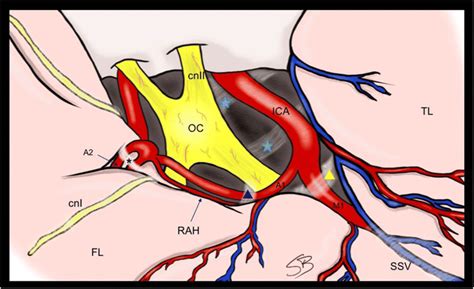 Lamina Terminalis Cistern