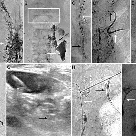 Pdf Percutaneous Extra Anatomic Lymphovenous Bypass Creation Toward