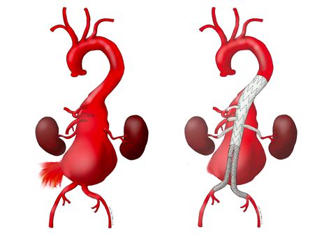 Preventing Spinal Cord Stroke Following Endovascular Thoracoabdominal