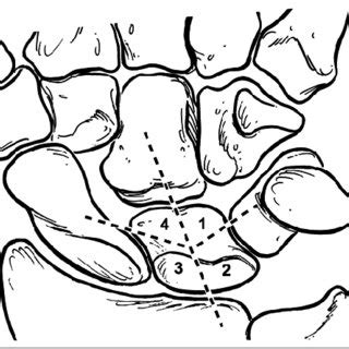 —schematic Drawing Of Wrist Joint Shows That Lunate Acts As