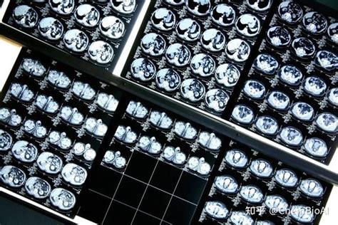 Nature 医学人工智能的未来 知乎