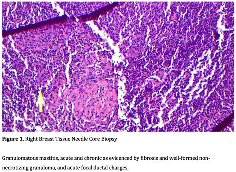 A Case Of Chronic Granulomatous Mastitis Caused By Corynebacterium