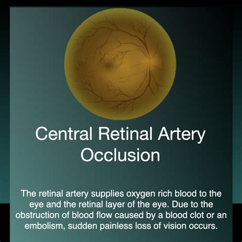 Central Retinal Artery Occlusion