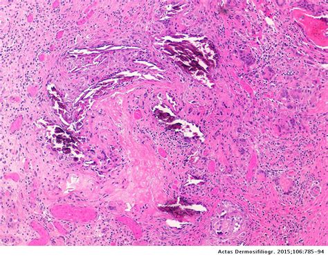 Calcinosis Cutis And Calciphylaxis Actas Dermo Sifiliográficas