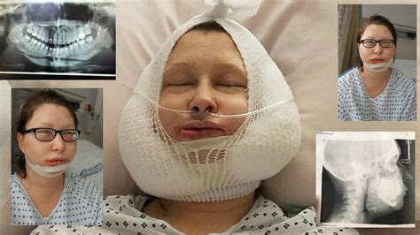 Underbite Surgery Procedures