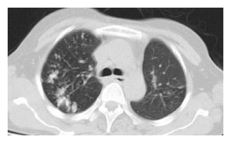 Multiple Irregular Opacities In Apical Segments Of Right Upper Lobe And