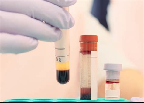 Eritrocitet Rruazat E Kuqe Të Gjakut Si Të Kuptojmë Vlerat Në