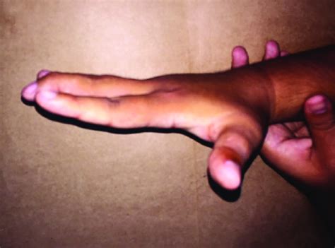 Post Operative Outcome Shows Full Pipj Extension With Extension Lag On Download Scientific