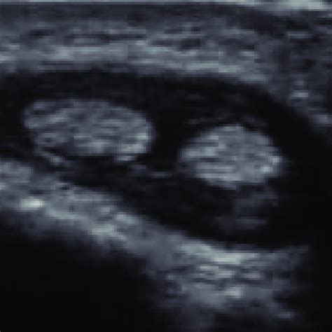 Fluid Collection In The Synovial Sheaths Of Apl And Epb Muscle Tendons Download Scientific