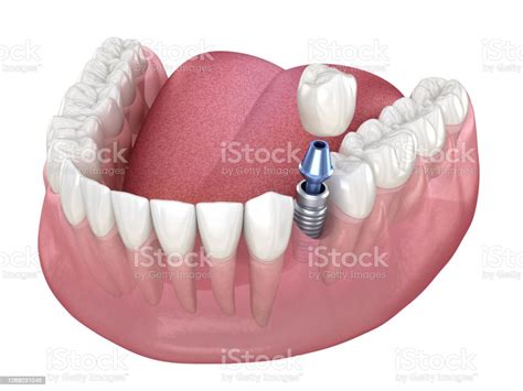 임플란트를 사용하면 전조 된 치아 회복 인간의 치아와 틀니 개념의 의학적으로 정확한 3d 그림 치아 임플란트에 대한 스톡 사진