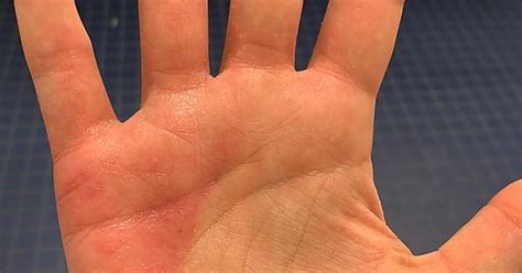 Progress Report On Treating Hand Eczema With Eucrisa Meme On Imgur