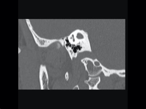 Normal Temporal Bone Ct With Annotated Images Radiopaedia 84293 99584