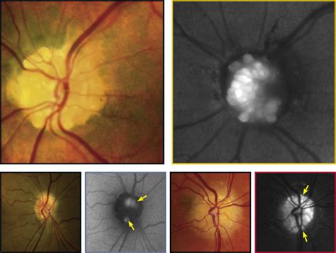 Congenital And Developmental Anomalies Of The Optic Nerve Ento Key