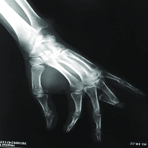 Hand X Ray Showing Dislocation Of The Pip Joint Of The Fourth Finger Download Scientific Diagram