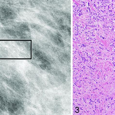 Patient 18 Had A 0 5 Cm Invasive Lobular Carcinoma In Her Download Scientific Diagram
