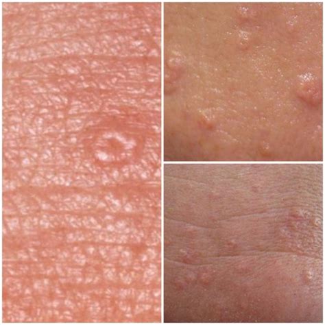 Sebaceoushyperplasia Face Fitness Skin Care