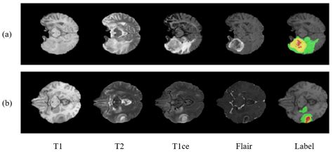 Bu Net Brain Tumor Segmentation Using Modified U Net Architecture