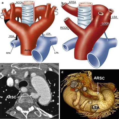 Aortic Arch Anomalies Radiology Key