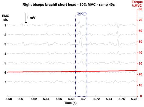 Multiple Zooms On An Emg Array Recording Of The Right Biceps Brachii