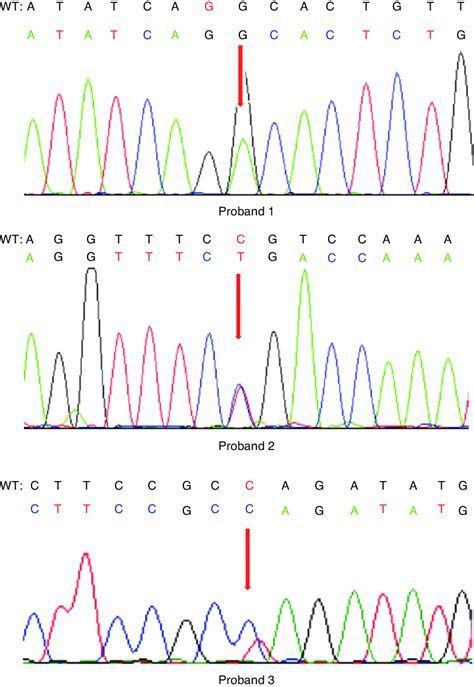 Missense Mutations Were Verified By Direct Sequencing In Three