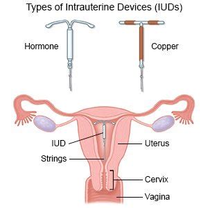 Real Tips About How To Check For Mirena Strings Securityquarter28