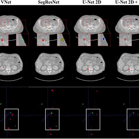 Comparison Of Different Method Segmentation Results With Large Tumors