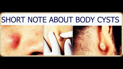 Why Does Heat Help Cysts At Leonard Gagliano Blog
