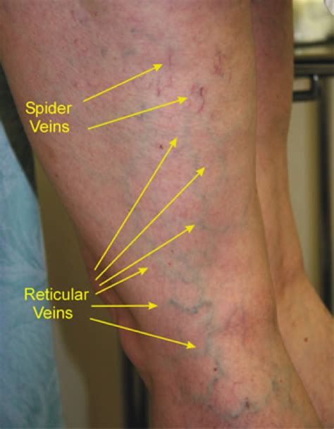 Varicose Veins Mark Odonnell Vascular Surgery
