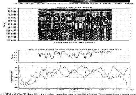 Figure 1 From A Multiresolution Wavelet Method For Characterisation Of Ventricular Late