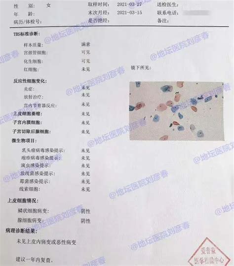 病例分享NO 1 26岁女孩HPV35型感染宫颈发生高级别病变 女性健康 妇产科 妇科症状 人乳头瘤病毒 HPV 感染 HPV感染
