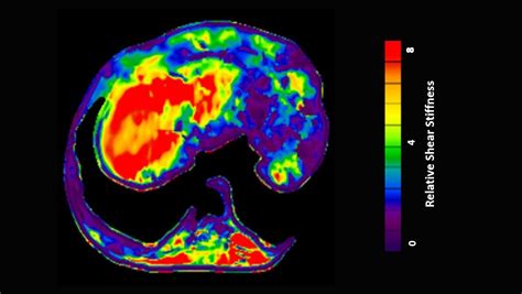 Liver Cancer Management Siemens Healthineers