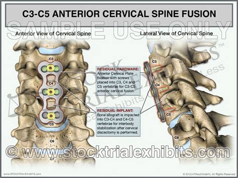 C3 C5 Spinal Fusion