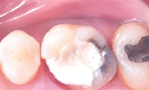 Mira A 10‑step Minimally Invasive Restorative Protocol