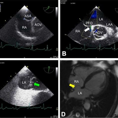 Transthoracic Echocardiogram Bubble Study In A Supine Position And