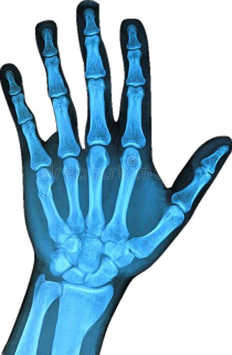 Xray Hand Stock Image Image Of Exam Human Bone Front 30365101 Hand Images X Ray Stock