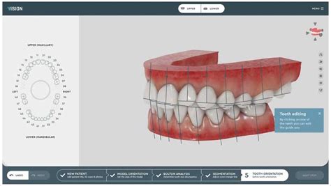 Clear Aligner Business 5 Things You Need To Consider