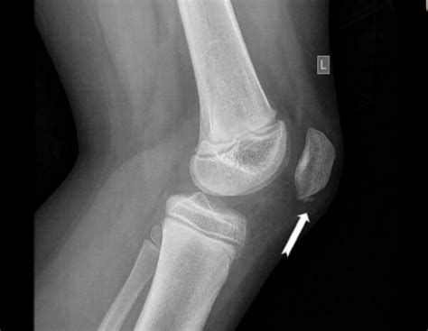 Patellar Apophysitis Wikism Sports Medicine Wiki